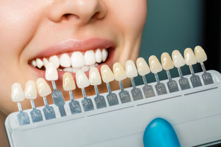 Achieve a Flawless Smile with Custom Dental Veneers